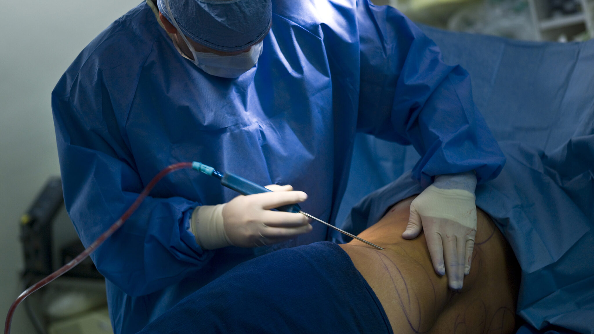 Liposuction in Chandigarh | Expert Body Sculpting India
